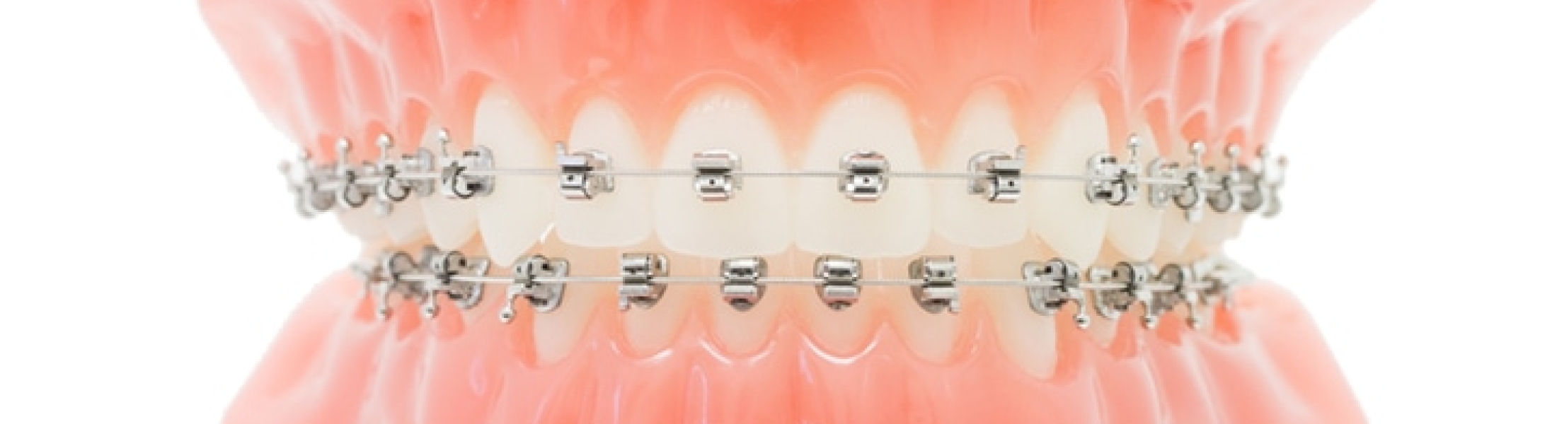 Wie funktioniert der Bionator? Alles, was Sie wissen müssen!